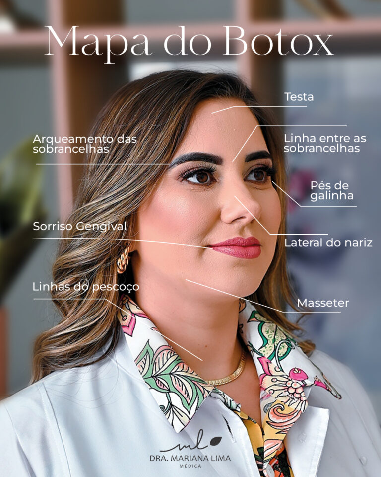 Mapa da Toxina Botulínica: onde podemos aplicar?! - Dra Mariana Lima